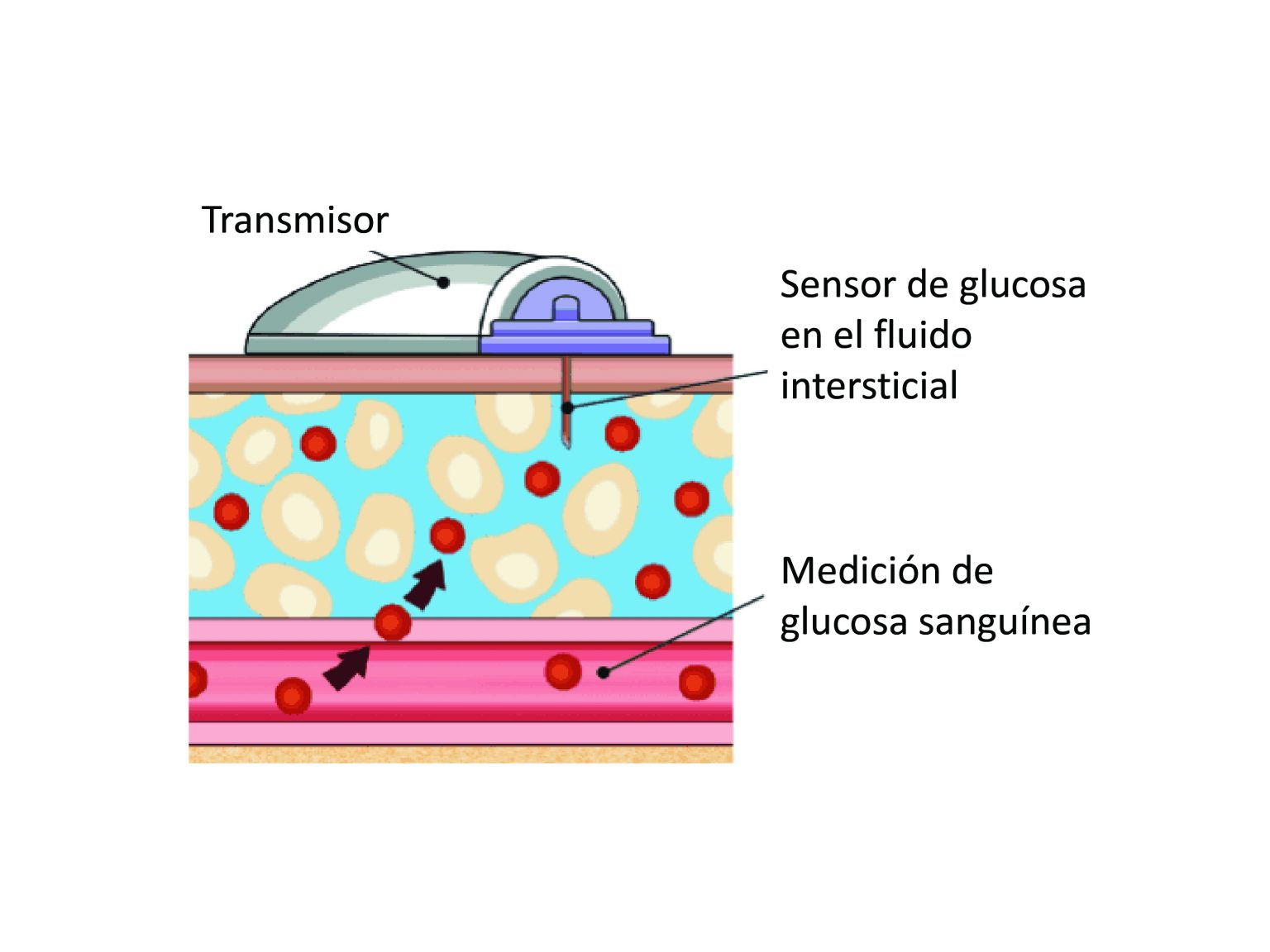 Monitoreo continuo de glucosa: una visión real que desafía el abordaje ...